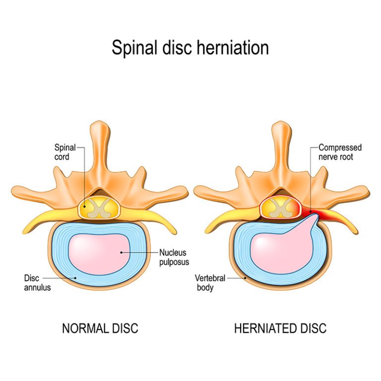 How Much is a Workers’ Compensation Settlement for a Herniated Disc in ...